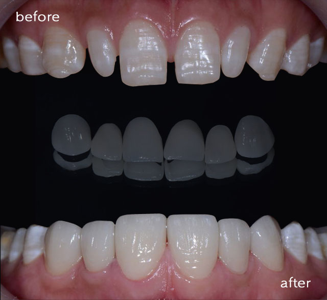 What are the precautions before getting dental veneers?_China Dental ...